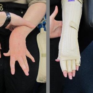 Dynamic Hand Splints | Second Skin AU/NZ