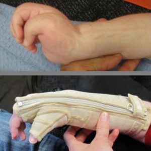 Dynamic Hand Splints | Second Skin AU/NZ
