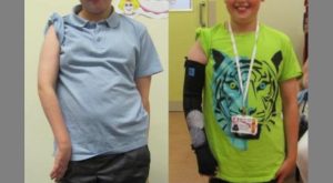 Dynamic Arm Splints | Second Skin AU/NZ